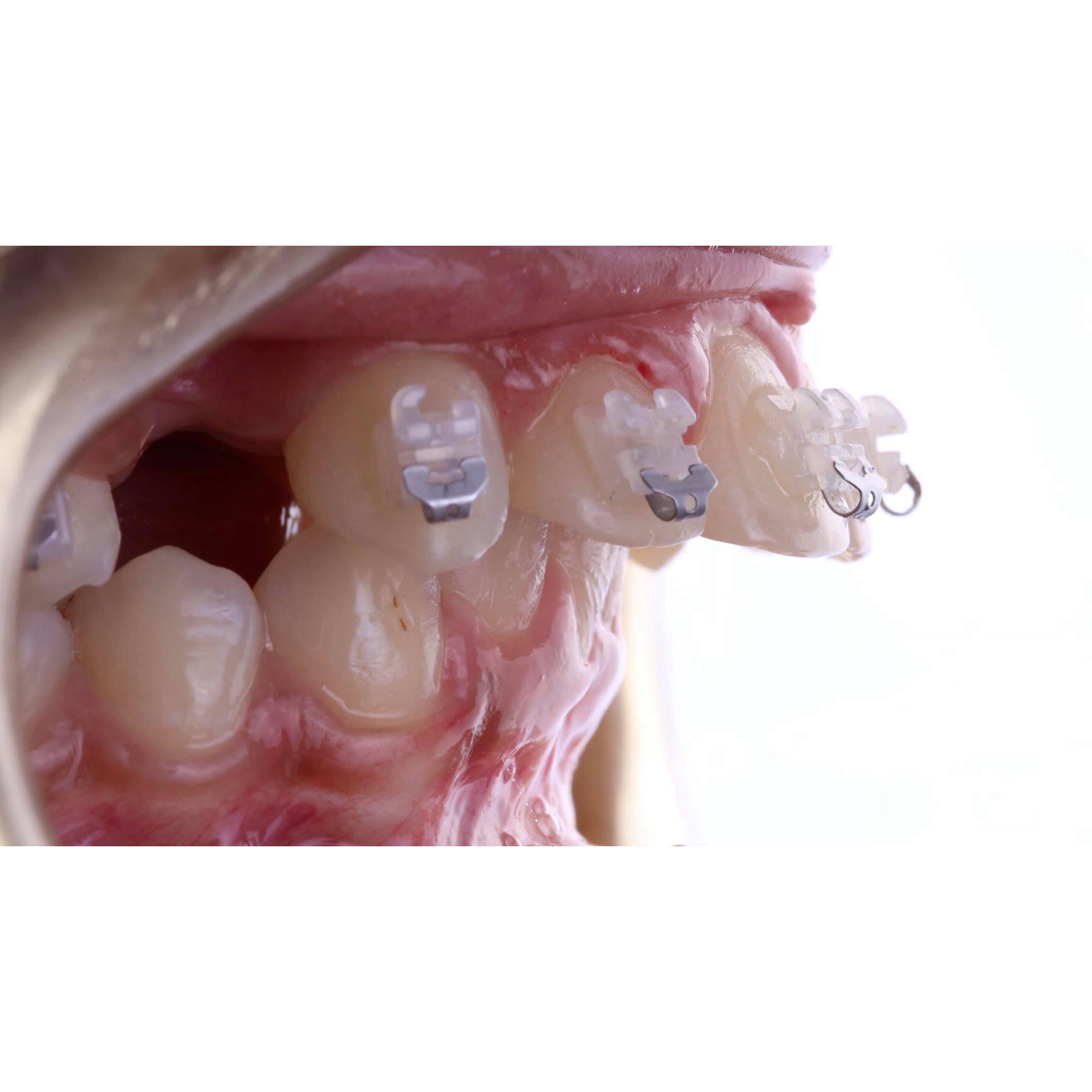 Tomy Clippy C Ceramic SL Bracket – orthobuy
